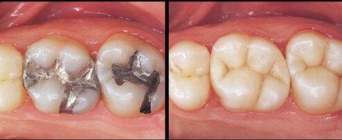 TOOTH DECAY & DENTAL FILLINGS – Green Valley Family Dentistry